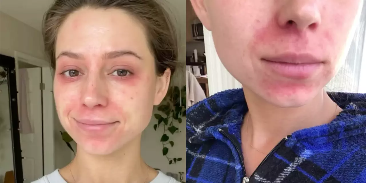 Kristina Schulman deel 'rou, emosionele, ongefiltreerde' foto's van haar periorale dermatitis-reis