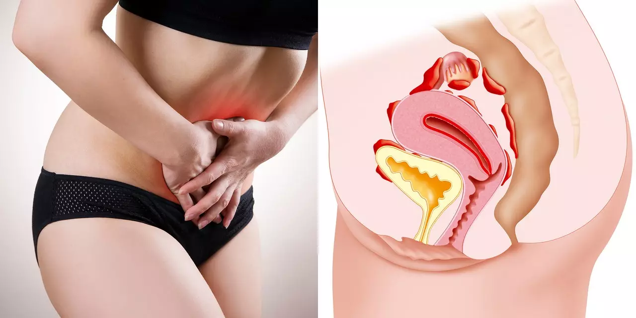 Semua Orang Bercakap Mengenai Endometriosis—Tetapi Apakah Ia Tepat?